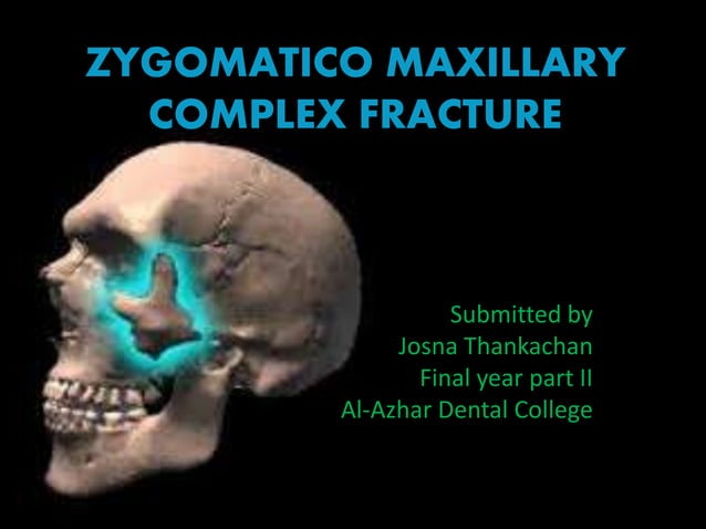 Zygomatic maxillary complex fracture | PPT