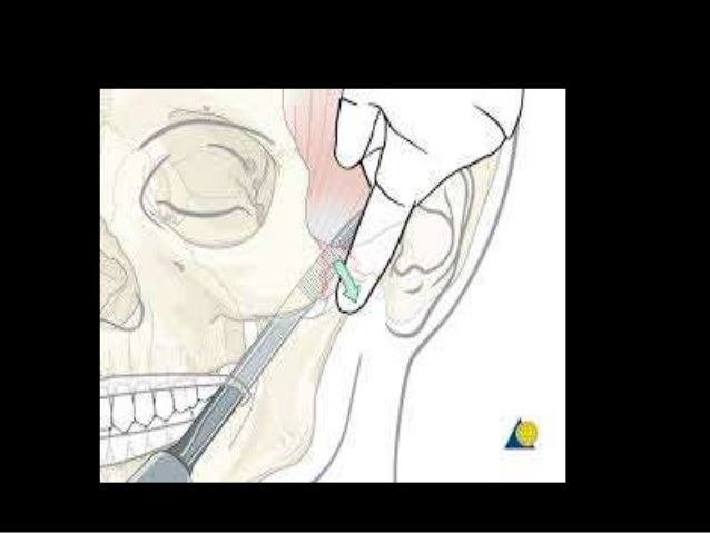 Zygomatic maxillary complex fracture
