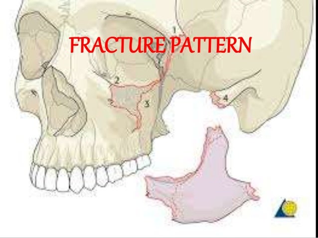 Zygomatic Maxillary Complex Fracture