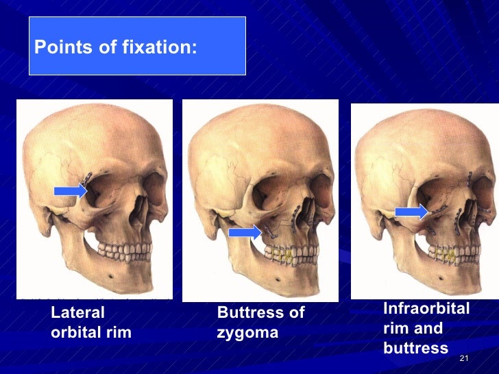Zygomatio Frontal Fracture