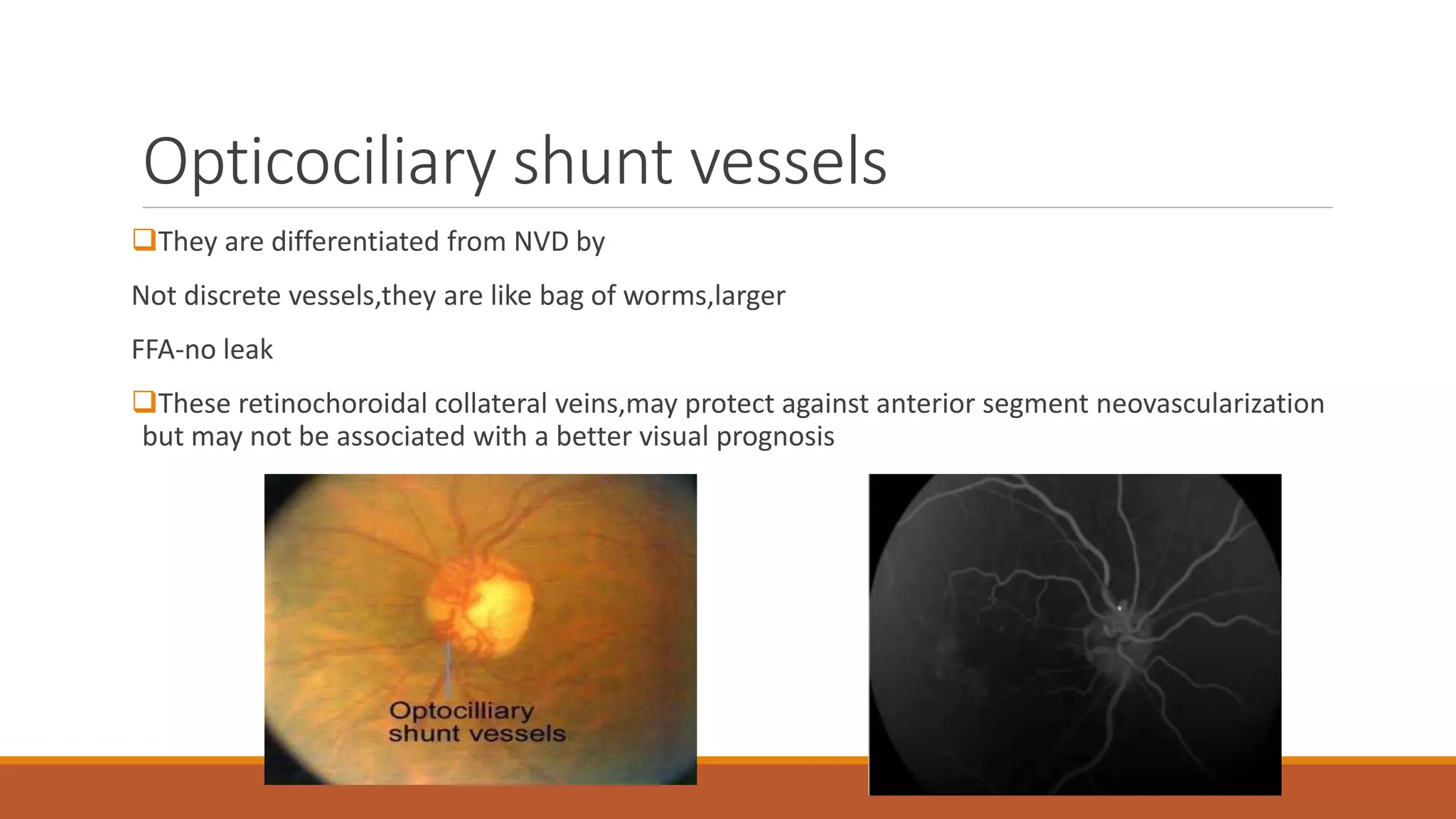 zzzCENTRAL RETINAL VEIN OCCLUSION.pptx