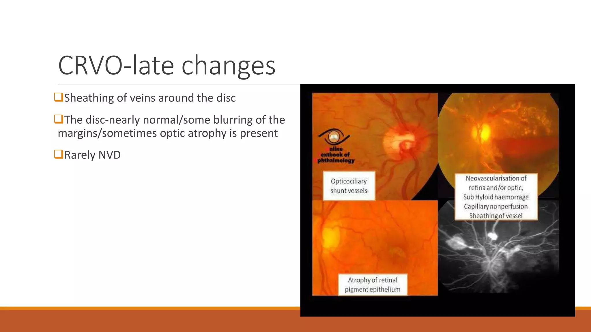 zzzCENTRAL RETINAL VEIN OCCLUSION.pptx