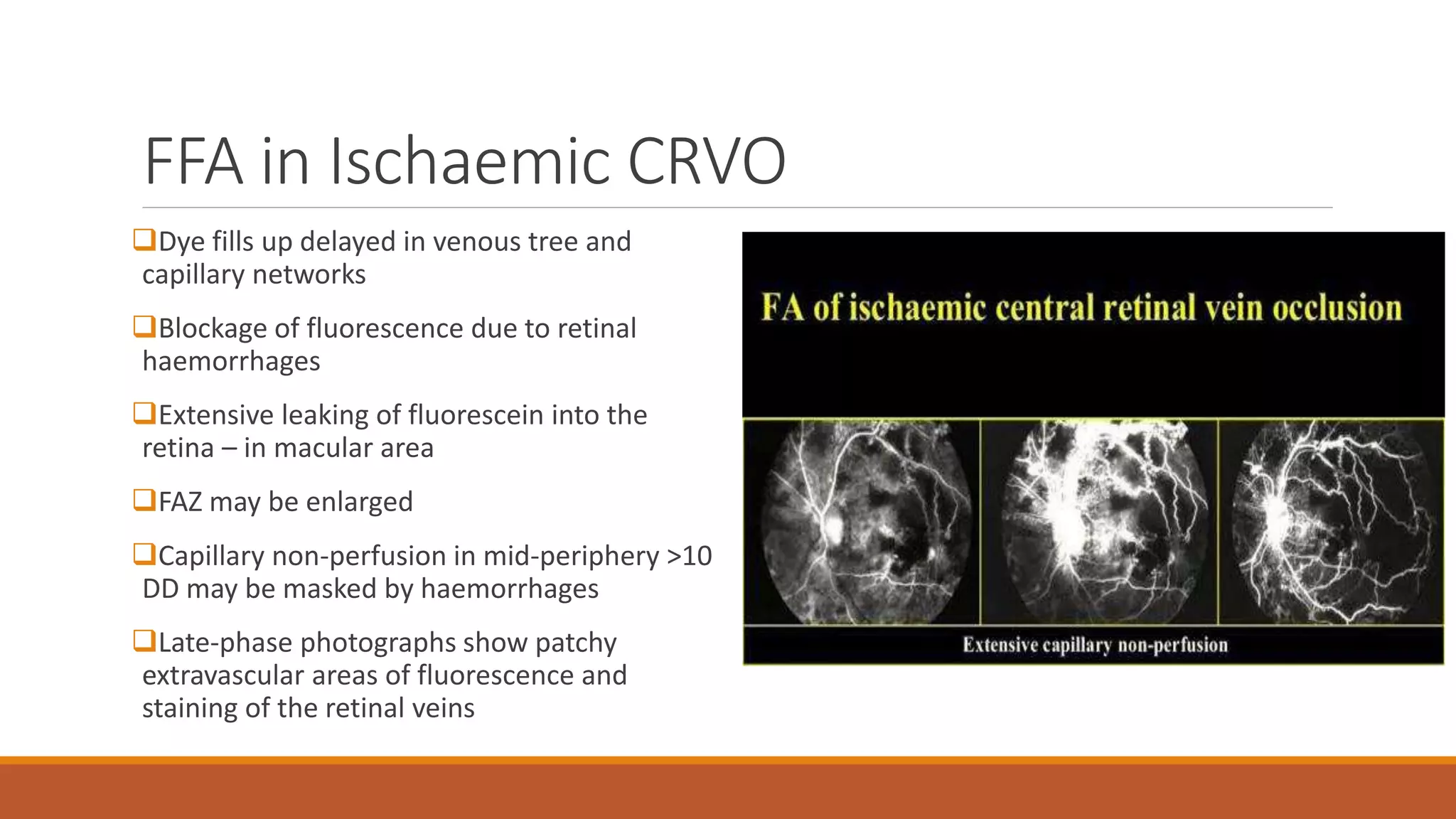 zzzCENTRAL RETINAL VEIN OCCLUSION.pptx