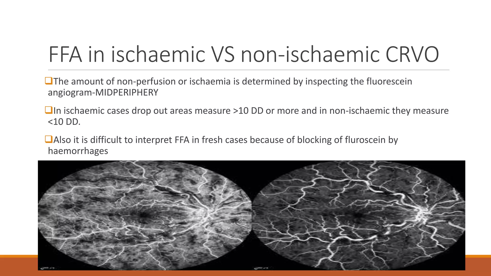 zzzCENTRAL RETINAL VEIN OCCLUSION.pptx